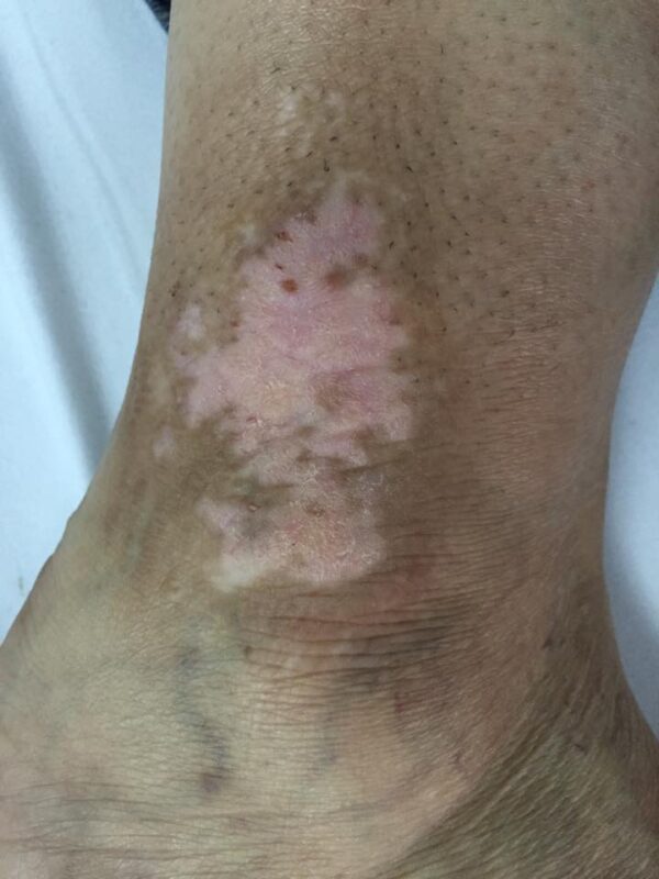 LIQUEN SIMPLE CRÓNICO - Dr. Eric Rojas - Dermatología Laser Center