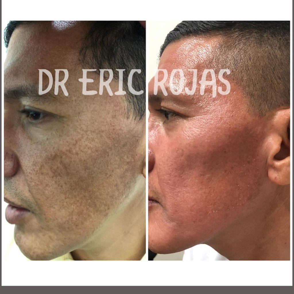 El HOMBRE TAMBIÉN SE MANCHA - Dr. Eric Rojas - Dermatología Laser Center