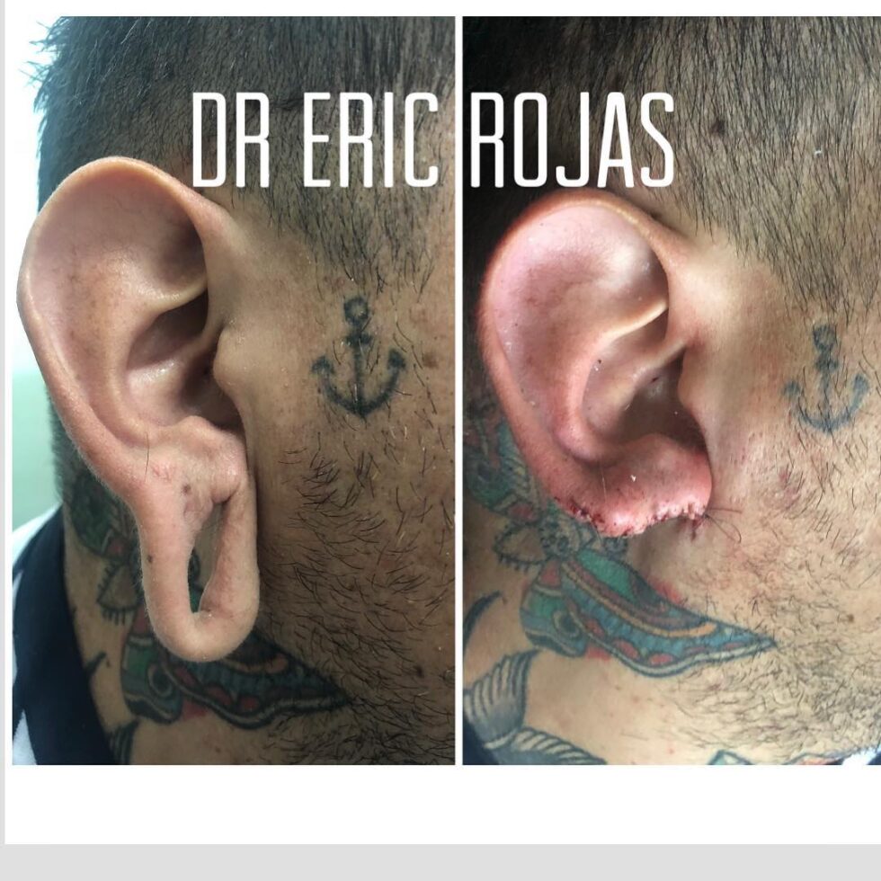 RECONSTRUCCIÓN DE OREJAS - Dr. Eric Rojas - Dermatología Laser Center