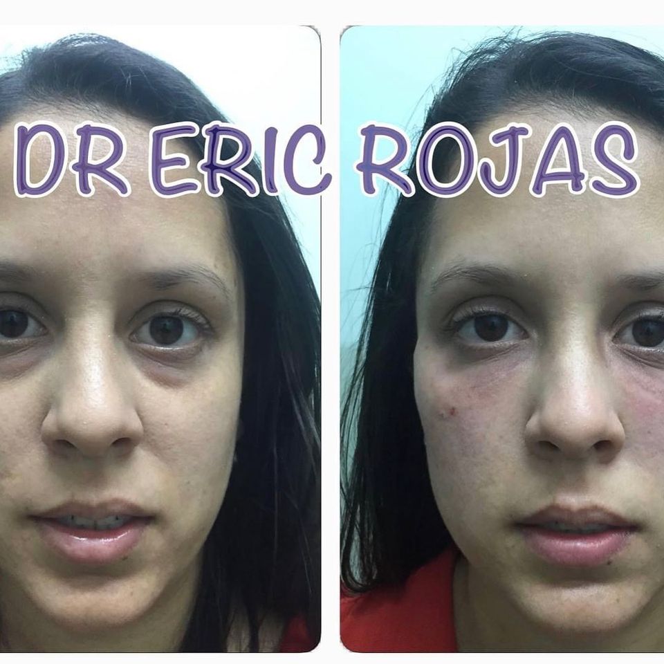Ojeras YA NO MÁS - Dr. Eric Rojas - Dermatología Laser Center