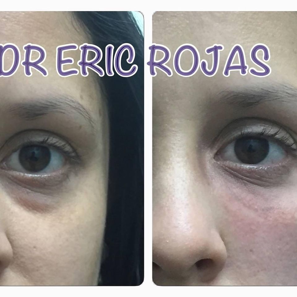 Ojeras YA NO MÁS - Dr. Eric Rojas - Dermatología Laser Center