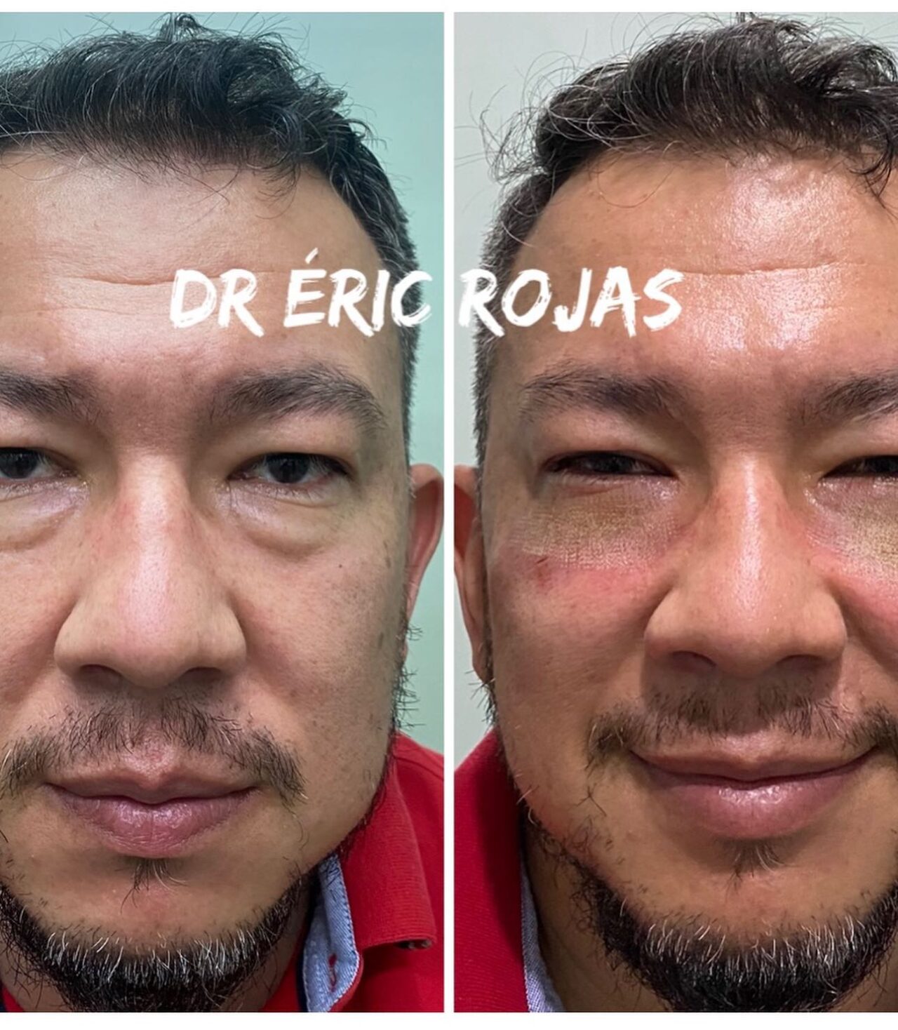 OJERAS CORRECCIÓN SIN CIRUGÍA DR ÉRIC ROJAS 22483535 en menos de 10 ...