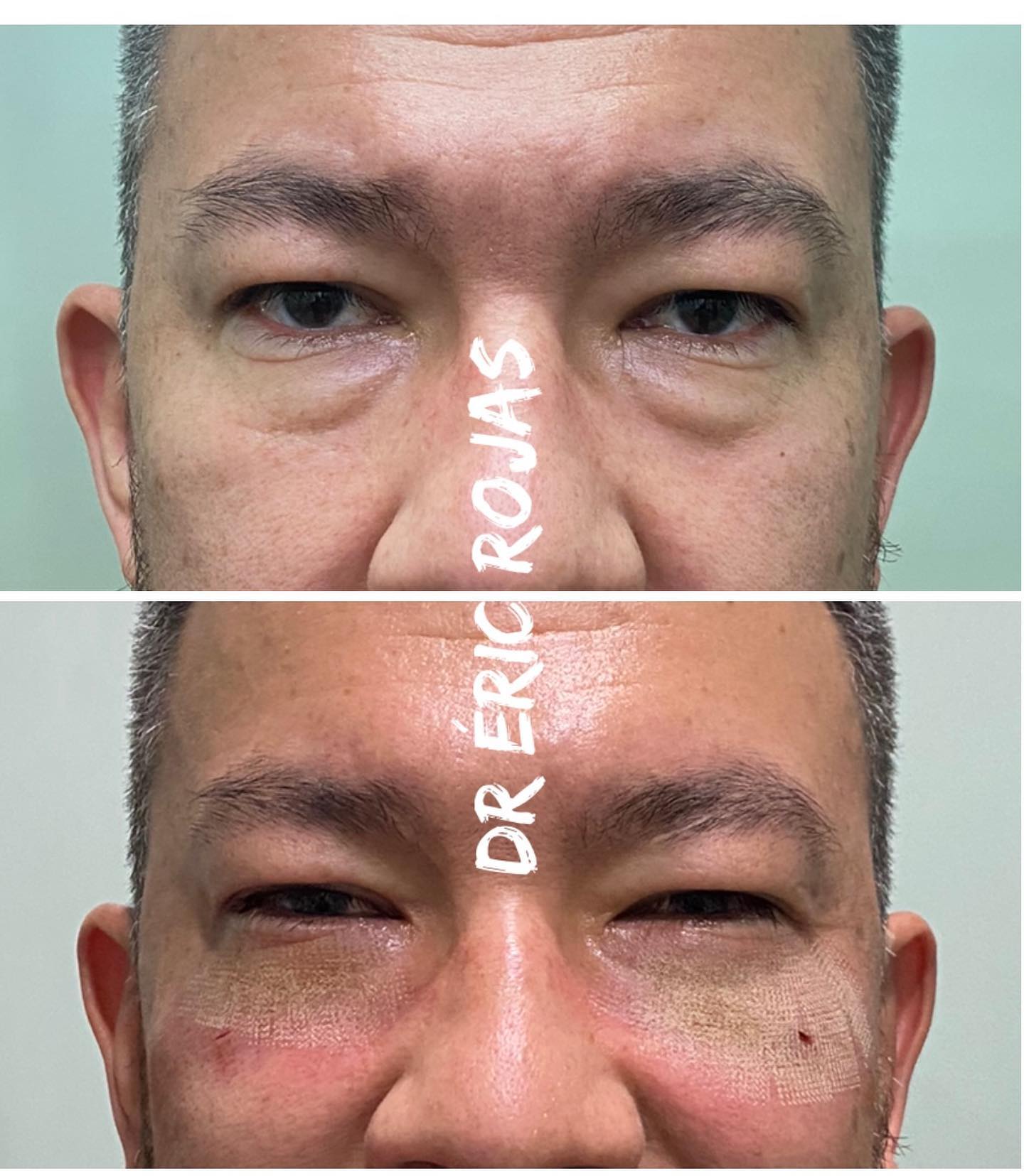 OJERAS CORRECCIÓN SIN CIRUGÍA DR ÉRIC ROJAS 22483535 en menos de 10 ...