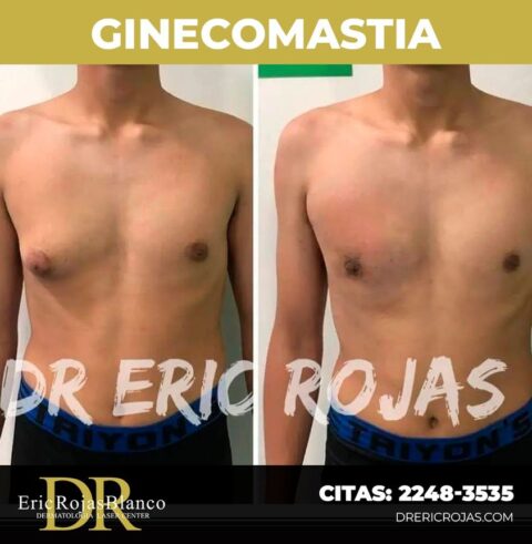 Solución de ginecomastia en paciente. - Dr. Eric Rojas - Dermatología ...